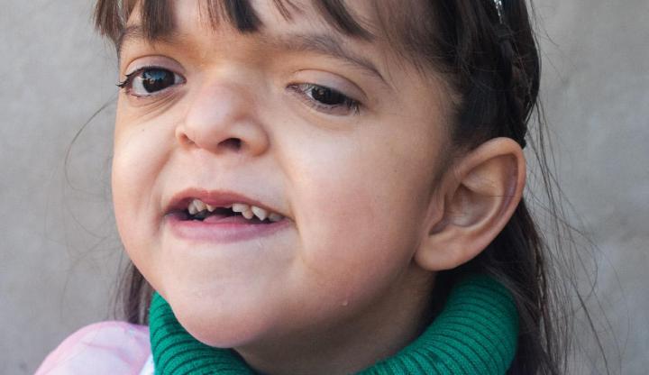 Shirley y el Síndrome de Apert - TvCrecer